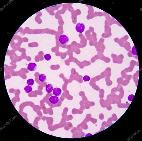 Eritrocitos O Eritrocitos Normales De Color Rojo A Rosa Más Pequeños 2023