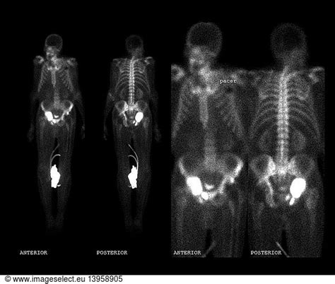 Pelvic Fractures Pelvic Fractures Bone Scan Abnormal Bone Scan