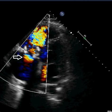 Continuous Wave Doppler Tracing Through The Tricuspid Valve Download