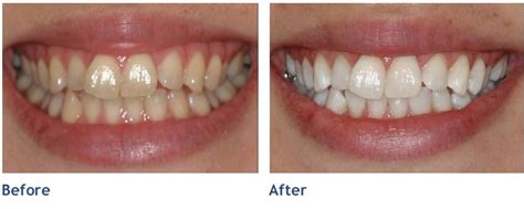 როგორ გავითეთროთ კბილები სახლის პირობებში პროფესიონალურ წმენდაზე ეფექტური მეთოდი სასარგებლო