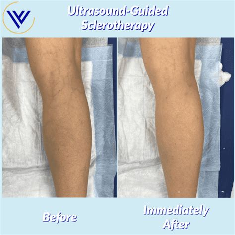 Before And After Wilton Ct And Fairfield Ct Center For Varicose Veins