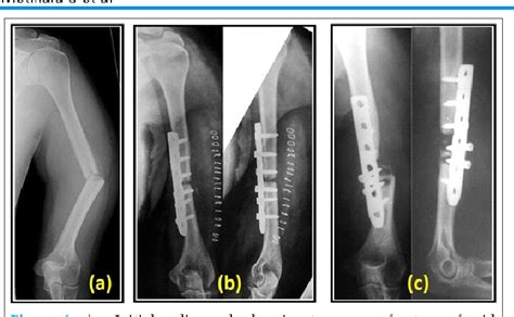 Figure 1 From Orthogonal Double Plating And Autologous Bone Grafting Of