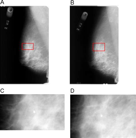 Detection Of Architectural Distortion In Prior Mammograms Via Analysis