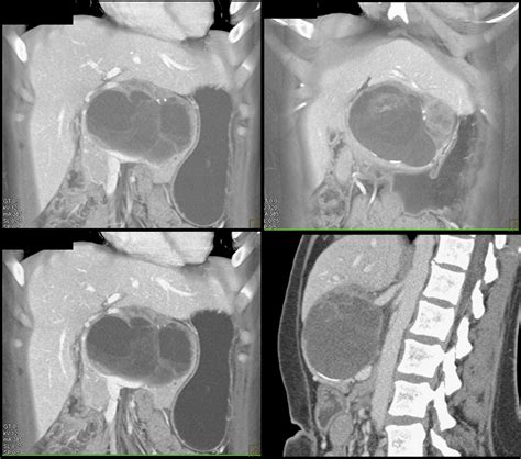 Gastrointestinal Learning Modules Ct Scanning