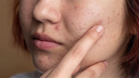 Почему появляются прыщи Natural
