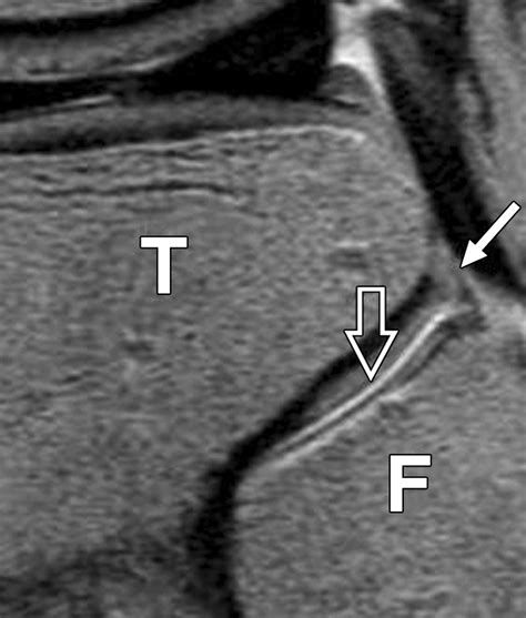 Communication Between The Proximal Tibiofibular Joint And Knee Via The Subpopliteal Recess Mr Communication Between The Proximal Tibiofibular Joint And Knee Via The Subpopliteal Recess Mr