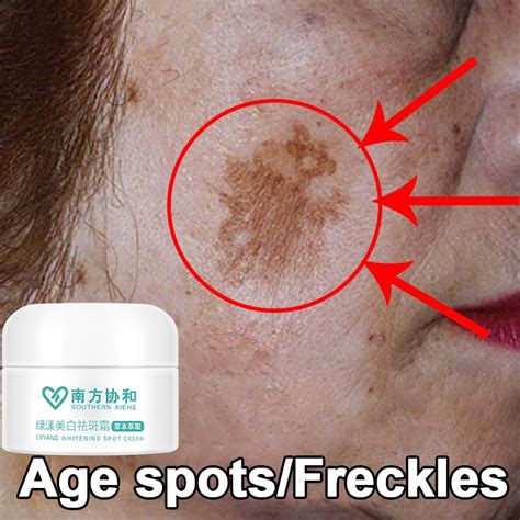 Freckle Cream Jeragat Treatment Skin Whitening Dark Spot Remover
