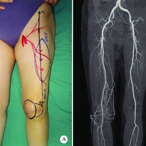A Preoperative View Showing The Location Of The Sarcoma And Flap