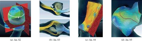 Exploration Of Different Datasets The Aneurysm Exploration Widget In