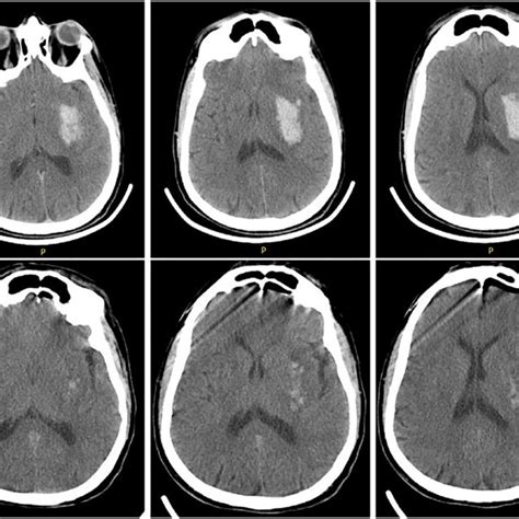 A End View Of The Nico 11 Mm Brainpath Endoport Containing The Nico