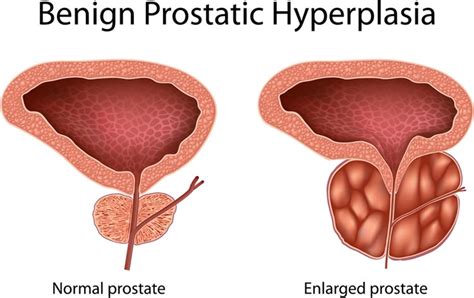 Prostate Enlargement Au