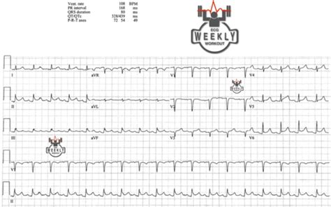 Ecg Basics And Fundamentals The Sensitive Vs Specific Definitions For