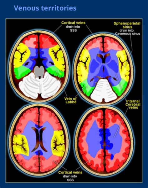 Venous Thrombosis Venousthrombosis Neurology Mri Ct Radilology Dmch… Sahariar Hossain
