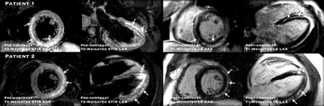 Age And Gender Effects On The Extent Of Myocardial Involvement In Acute Myocarditis A