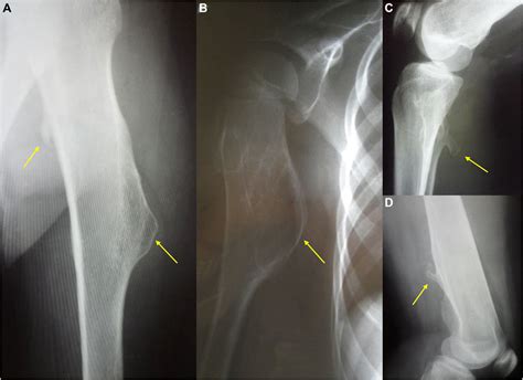 Treatment For Exostosis