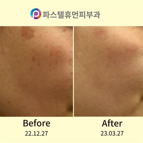 피부과전문의가 추천하는 기미치료 홈케어 네이버 블로그