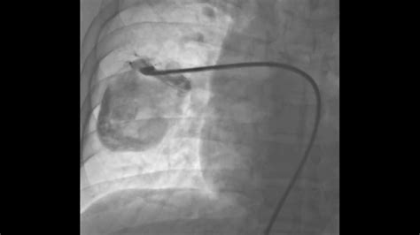 Transcatheter Closure Of A Huge Pulmonary Arteriovenous Fistula