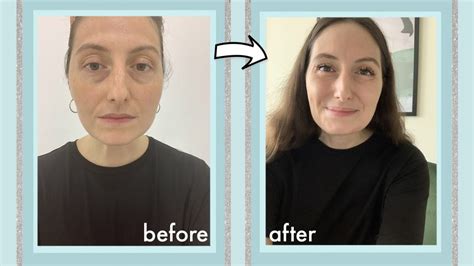 I Tried A Laser Treatment For Under Eye Bags And The Results Were