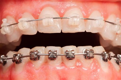 Braces Fixed Or Removable Points You Need To Know