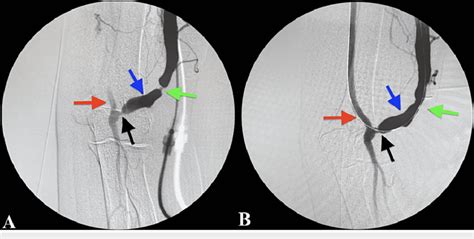 Angiography Of Arteriovenous Fistula With Arterial Anastomosis