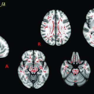 Results Of Tract Based Spatial Statics Analysis Comparing Fractional