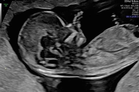 Nuchal Translucency Scans Early Anatomy Scans — Trinity Imaging