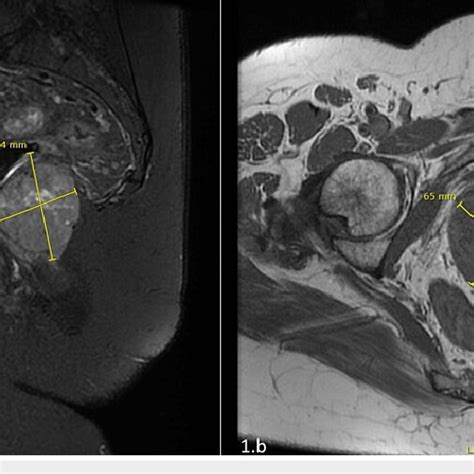 Mri View Of The Pelvis A Magnetic Resonance Imaging Axial View Of The