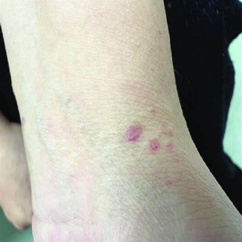 Lichen Planus Polygonal Violaceous Papules On The Right Forearms And