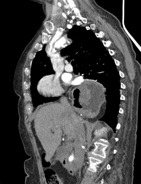 Intrathoracic Stomach Image