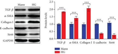The Progression Of EMT HG Induced HK2 Cells Is Associated With Reduced