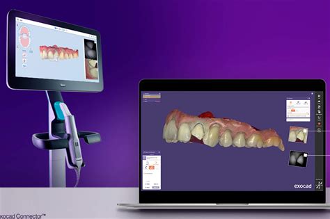 Align Introduces Latest Itero Exocad Connector Software Dentistry