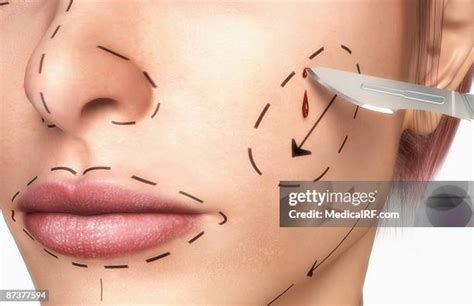 Rhytidectomy Photos And Premium High Res Pictures Getty Images