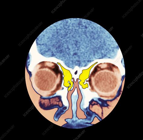 Nose And Sinuses Ct Scan Stock Image P4100073 Science Photo Library