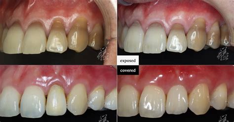 Ctg 外露的效果 Effect Of Ctg Exposed On Root Coverage