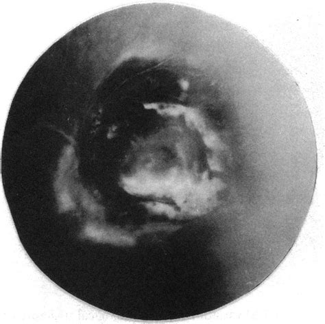 Late Non Homogeneous Staining Ofthe Tumour Download Scientific Diagram