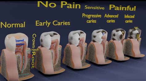 Caries Teeth Severity Schematic Cut Sectional Superhive Formerly