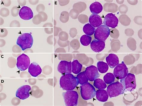 Cuplike Nuclei In B Cell Acute Lymphoblastic Leukemia With Dux4