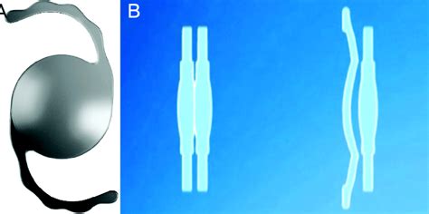 A Photograph Of The Sulcoflex Intraouclar Lens Iol The 6 5 Mm Download Scientific Diagram
