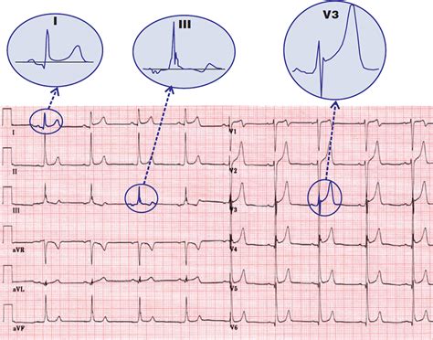 Benign Early Repolarisation Ecg Book