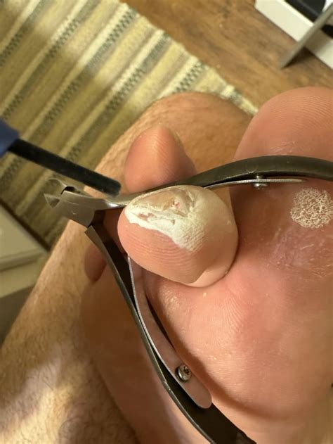 Deep Toenail Root Rwarts