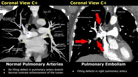Ct Angiography Normal Vs Pulmonary Embolism Polo Mint Railway Track Signs Acute And Chronic