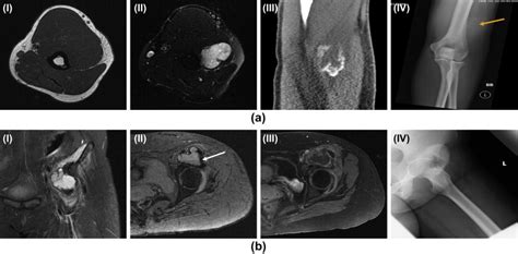 Characterising Benign Fibrous Soft Tissue Tumours In Adults Why Is It