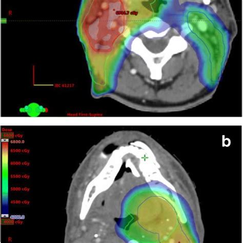 Normal Tissue Dose Constraints Used In Rtog 1014 For Partial Breast