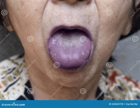 Cyanotic Lips Or Central Cyanosis At Asian Chinese Old Woman Stock