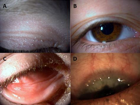 Allergic Keratoconjunctivitis Causes Symptoms Diagnosis Treatment