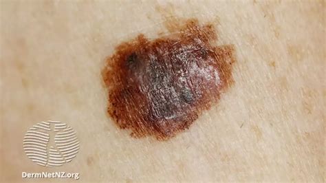 Til For Melanoma What Are The Costs And Challenges United States