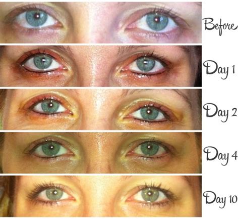 Permanent Eye Makeup Healing Time Mugeek Vidalondon