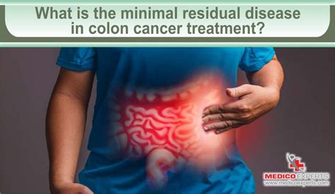 Is Colon Cancer Curable Things You Need To Know
