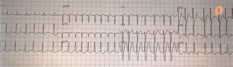 Smith Modified Sgarbossa Rekgs