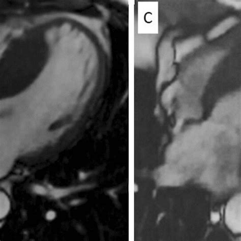Left Ventricular Hypertrophy Patterns In Hypertrophic Cardiomyopathy